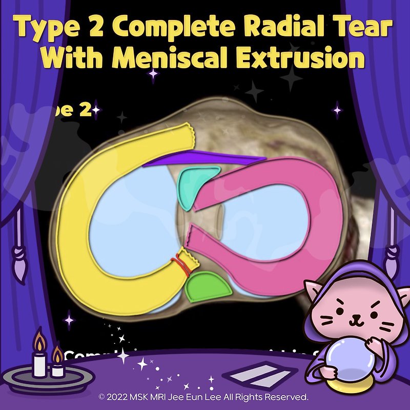 (Fig 1-B.32) Type 2 Complete radial tear with meniscal extrusion