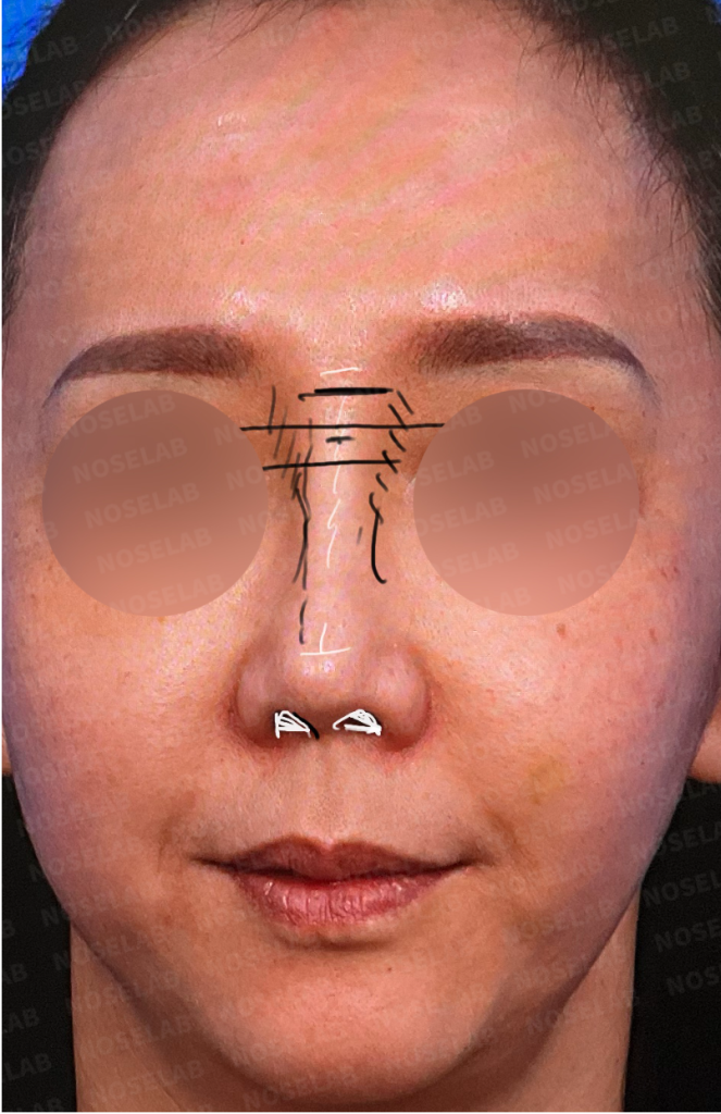 Nose Bridge Starting Point Lowering – Noselab Dr. Chayoung Kang