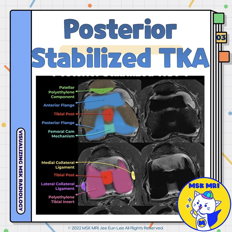 (Fig 5-D.03) MRI Findings of Posterior Stabilized TKA: Part 1