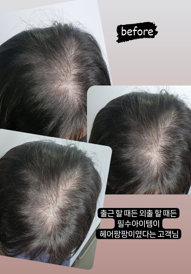 여자 정수리 탈모 고민 해결 헤어팡팡이 잘가👋 부천역 두피smp