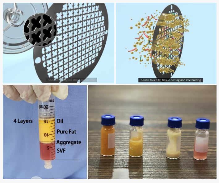 미세지방-Mechanical SVF by Adinizer kits. Series 1 - MSK,Orthobiologic