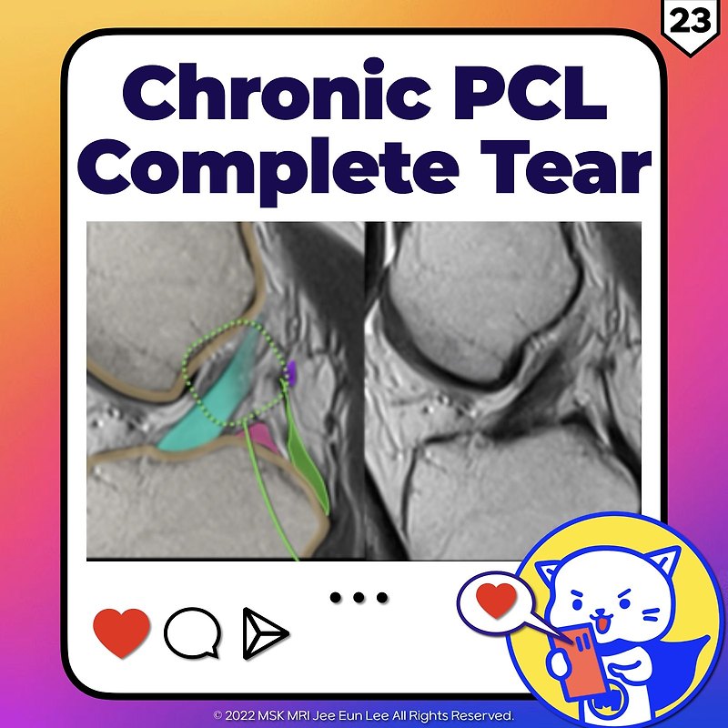 (Fig 2-E.23) Chronic Complete Tear of the PCL - Part 1