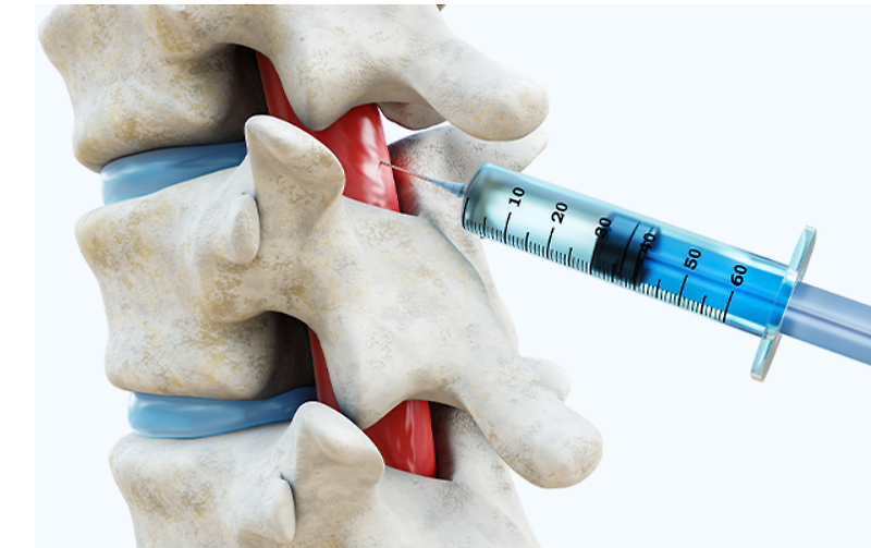 신경차단술(Nerve Block) 치료 원리 및 효과 알아보기