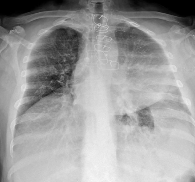 Chest apical lordotic, Decubitus
