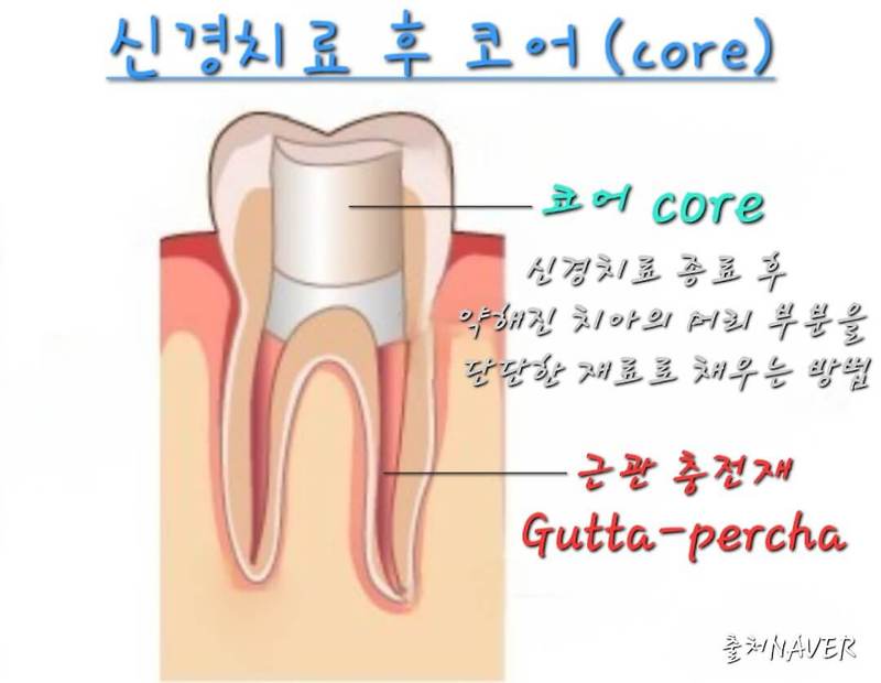 신경 치료 후 코어 Core 중요성 And 재료 종류 And 치료 방법