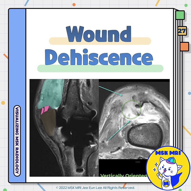 (Fig 5-D.27) Quadriceps Tendon Rupture and Wound Dehiscence