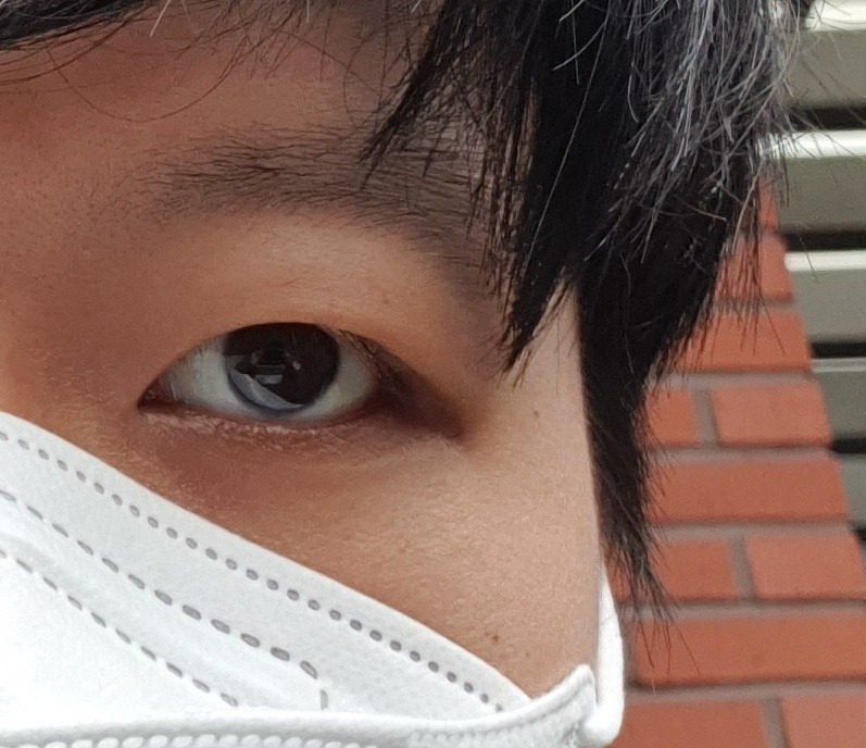 눈매교정 수술 후기 :: kunaDiary();