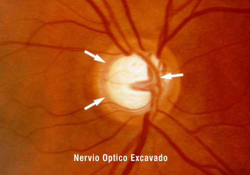 Temporal unfolding, Nasal cupping, Overpass cupping