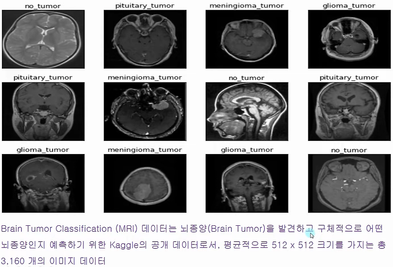27. TensorFlow 2.x - Brain Tumor Classification 예제