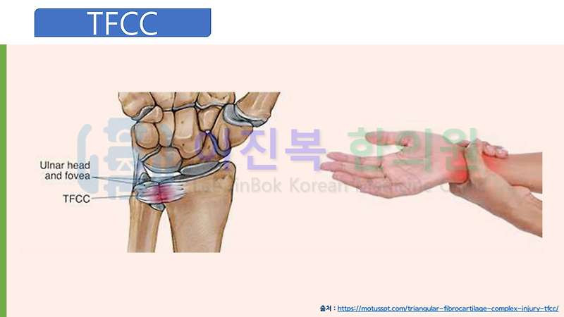 전주 이진복한의원 삼각 섬유 연골 복합체 병변(TFCC lesion)