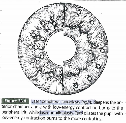 아르곤 레이저 주변홍채 성형술(Argon Laser Peripheral iridoplasty, ALPI, LPI, Argon ...