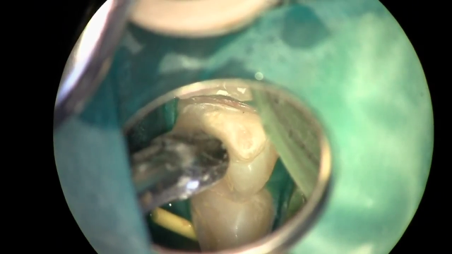 MTA직접치수복조, RetroMTA Direct pulp capping