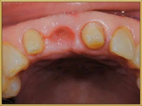 [수원치과] 충치로 뺀 앞니 브릿지 치료 - PFM브릿지, 오베이트 폰틱(Ovate pontic)