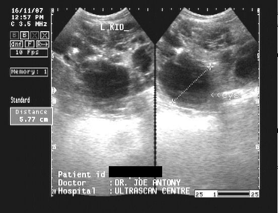 Autosomal Dominant Polycystic Kidney Disease (ADPCK):