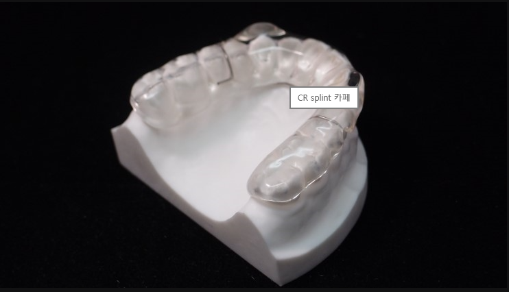선셋 스튜디오 :: cr splint에 관하여