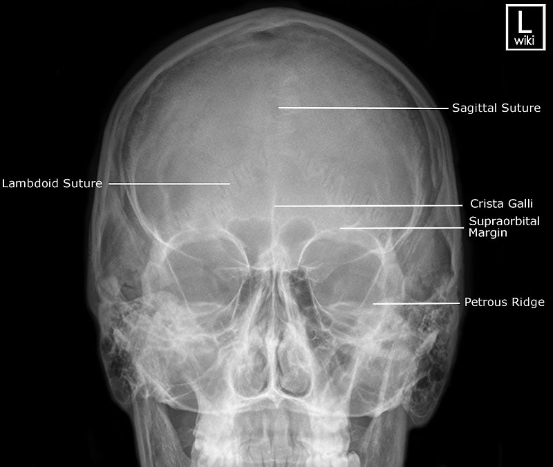 skull AP :: 방사선사의 병원이야기