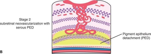 망막혈관종성증식, Retinal angiomatous proliferation, RAP 의 임상양상, 증상, 검사 소견