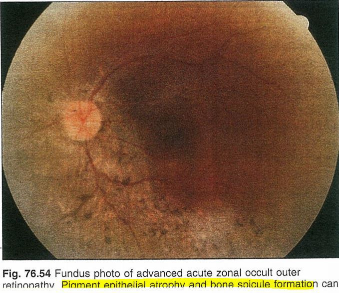 급성 대상 잠재 외망막병증 (Acute Zonal Occult Outer Retinopathy, AZOOR)