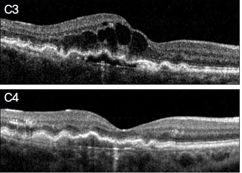 망막혈관종성증식 (Retinal angiomatous proliferation, RAP)의 치료