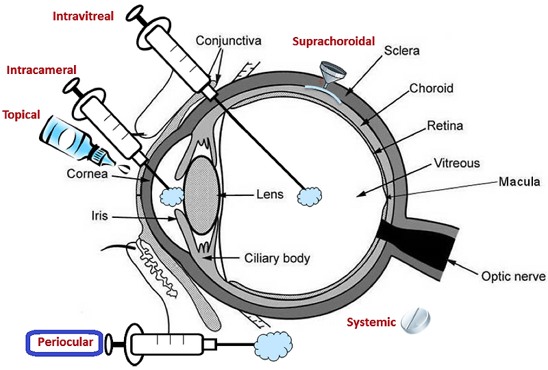 테논낭하 주사술, 눈주위 주사술, 테논낭하(후테논낭하) 트리암시놀론(스테로이드) 주입술 (Posterior Subtenon ...