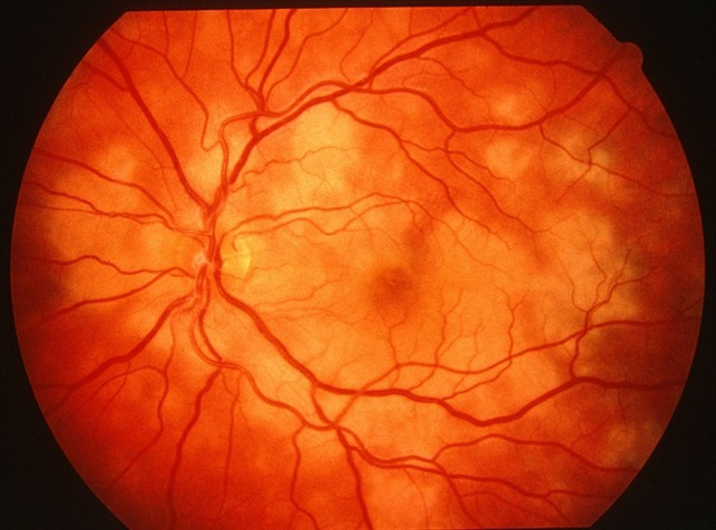 감기 걸리고 양눈 시력이 떨어진다?? 급성 후부 다발성 판모양 색소상피증 (Acute Posterior Multifocal ...