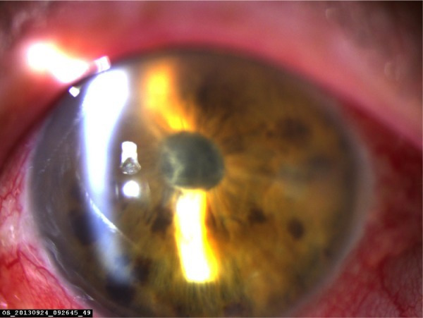 백내장 수술, 안과수술 후 발생한 독성 전방 증후군 (Toxic Anterior Segment Syndrome, TASS, 타스)