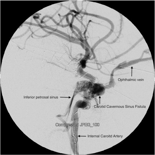 직접 목동맥 해면굴 샛길(직접 경동맥 해면정맥동 루, Direct Carotid Cavernous Fistula, Direct CCF)