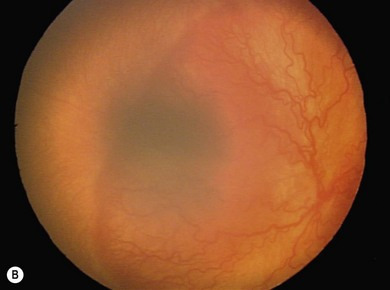 Aggressive Posterior ROP(AP ROP) , Prethreshold(전문턱), Threshold(문턱 단계 ...
