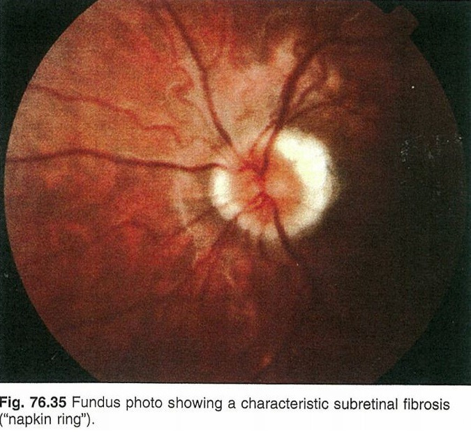 전체포도막염과 동반된 다초점(다소성) 맥락막염 (Multifocal choroiditis (MFC) with Pan ...