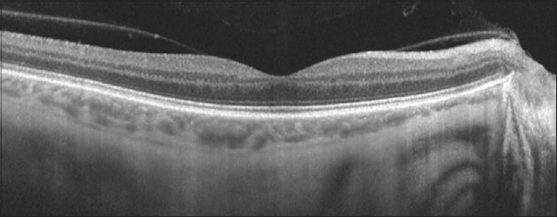 유리체 황반 견인 증후군, VitreoMacular Traction Syndrome, VMTS 의 정의, 임상양상, 증상, 검사 ...