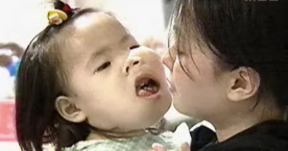 안면 장애로 숨쉬기조차 힘든 세 살 아연이