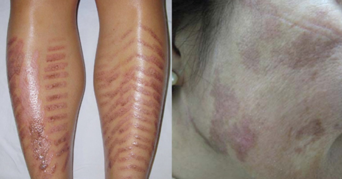 피부미용사 레이저 사용 여전 부작용 多