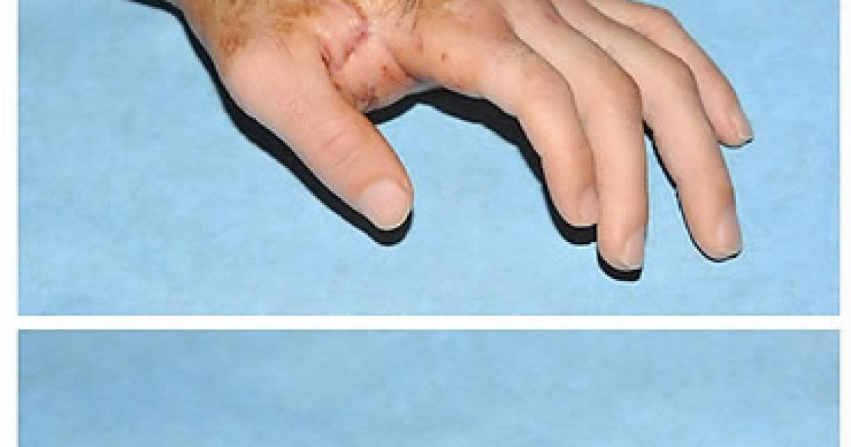 SPAIN MEDICINE HAND IMPLANTATION