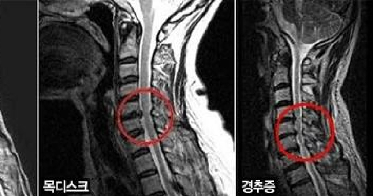 목디스크 초기 증상 과연 당신은