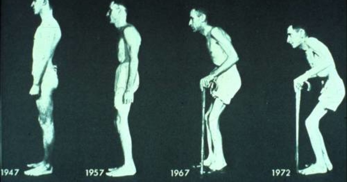 No cure yet for spine-fusing condition
