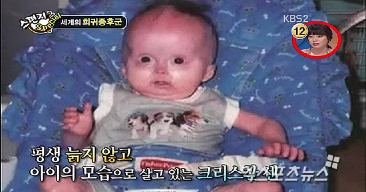 하이랜더 증후군 평생 늙지 않아 실제로 가능