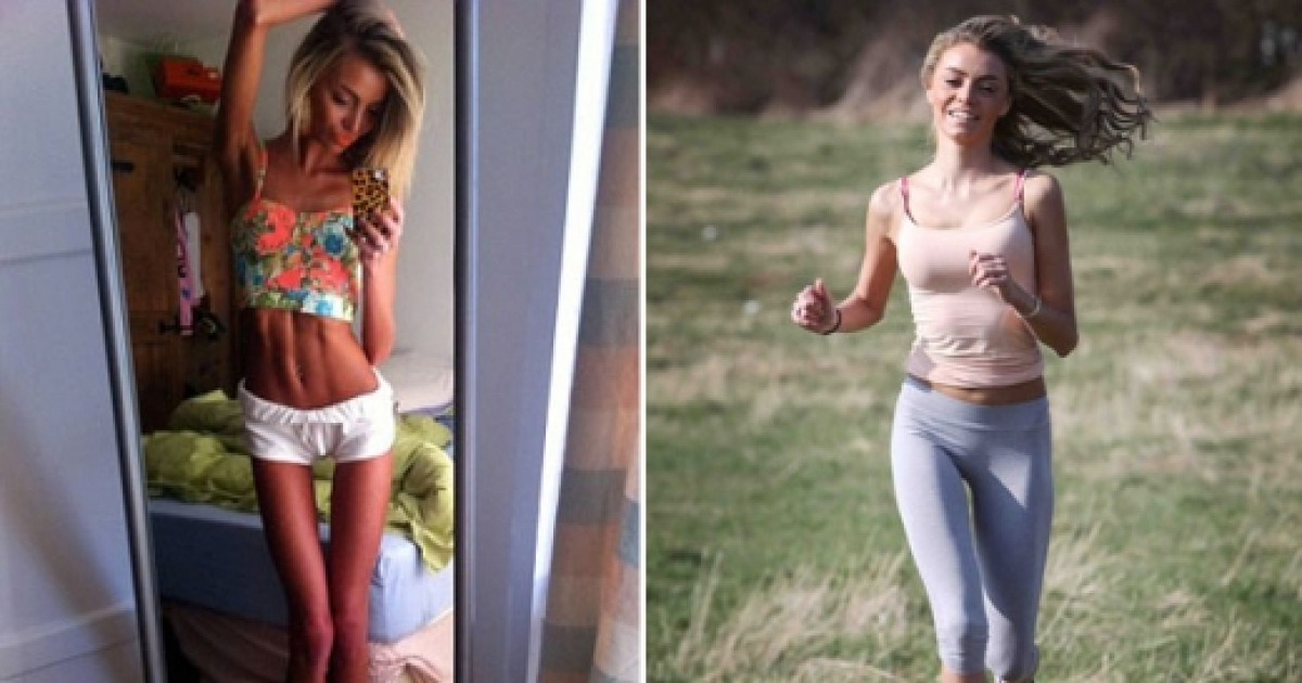 몸무게 39kg '거식증' 극복하고 뷰티퀸 된 19세의 사연