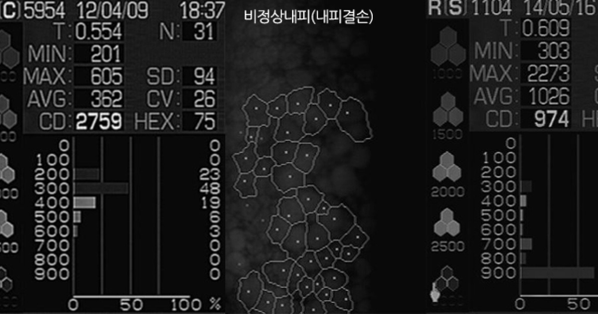 아쿠아ICL 렌즈삽입술, UBM검사와 각막내피세포 검사 필수