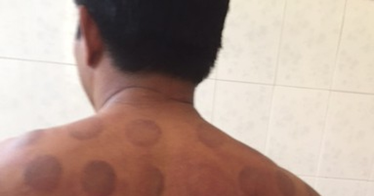 Cambodia Cupping and Coining