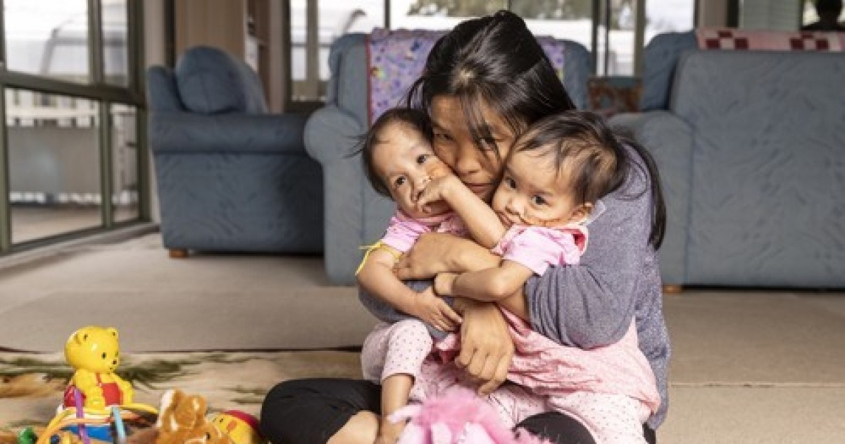AUSTRALIA CONJOINED TWINS
