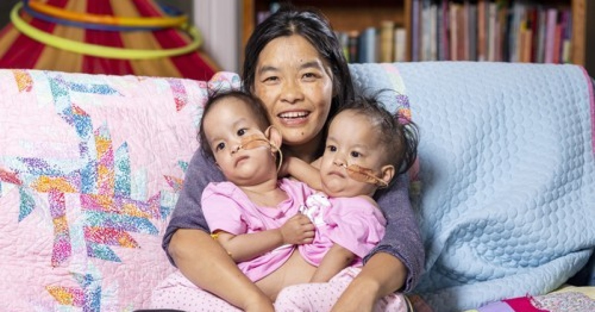 AUSTRALIA CONJOINED TWINS