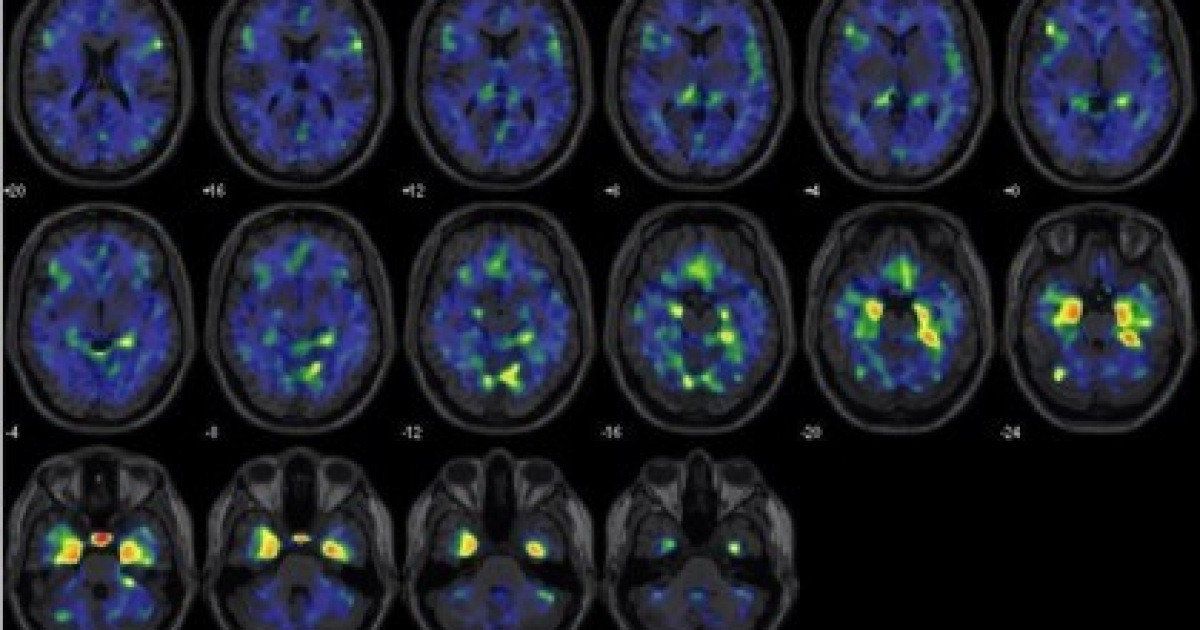 Football Concussions Brain Scans