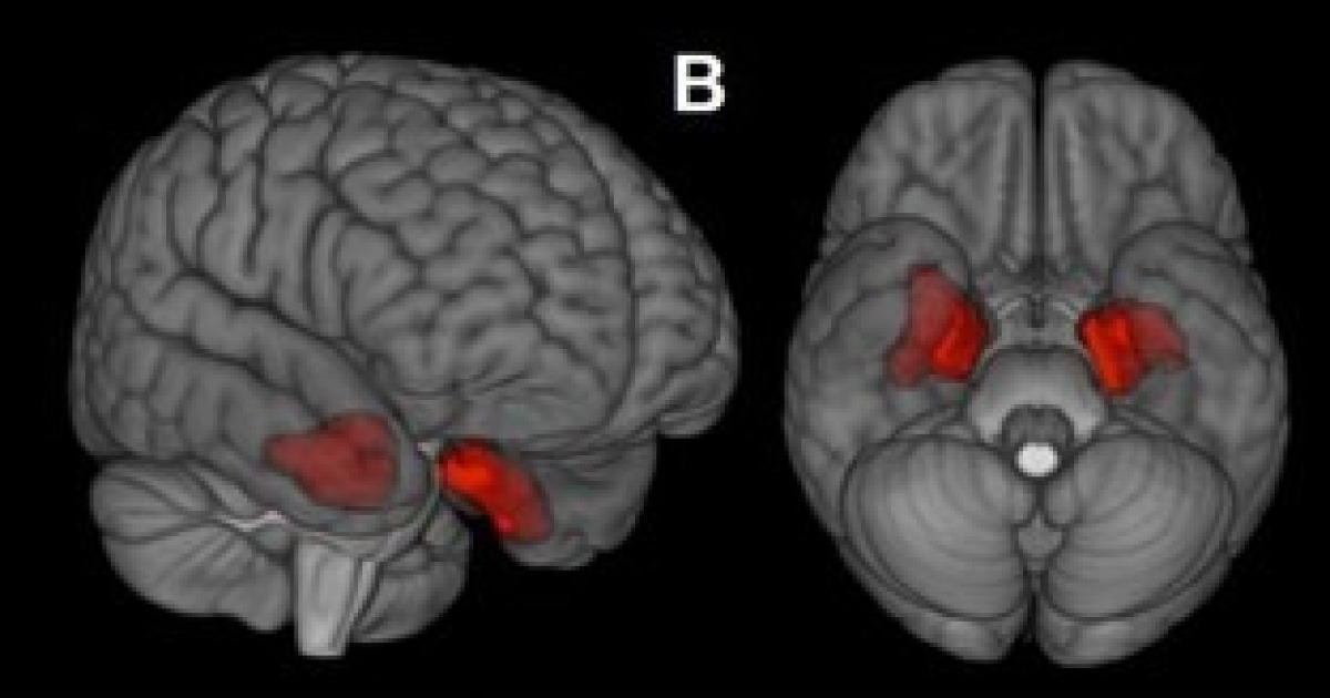 Football Concussions Brain Scans