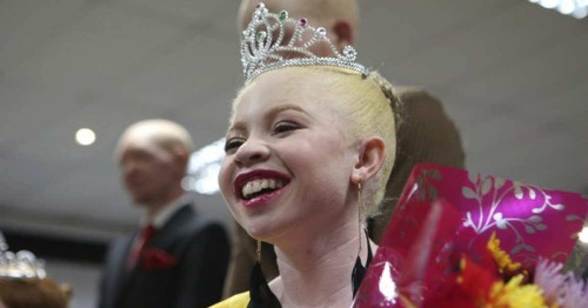 Zimbabwe Albinism Pageant