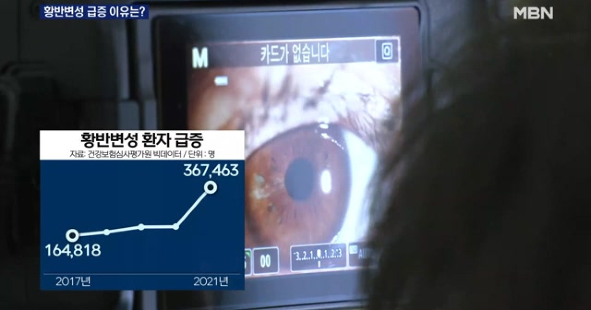 실명 초래하는 황반변성 환자 급증 장년부터 정기검사 필요