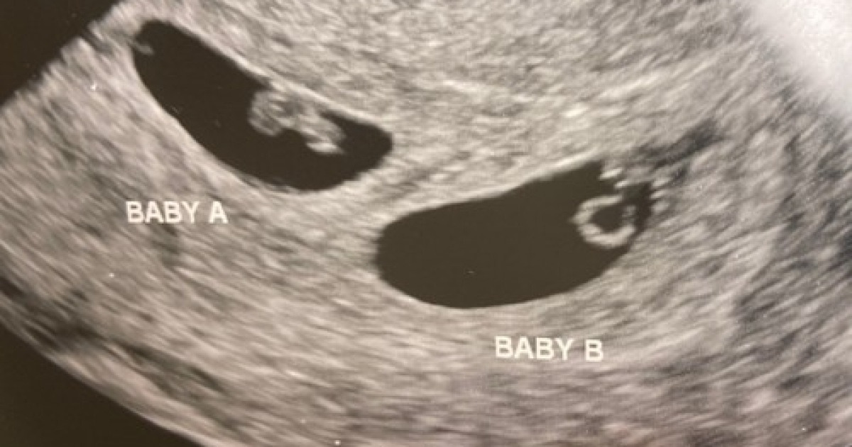 USA FROZEN EMBRYO TWINS BIRTH