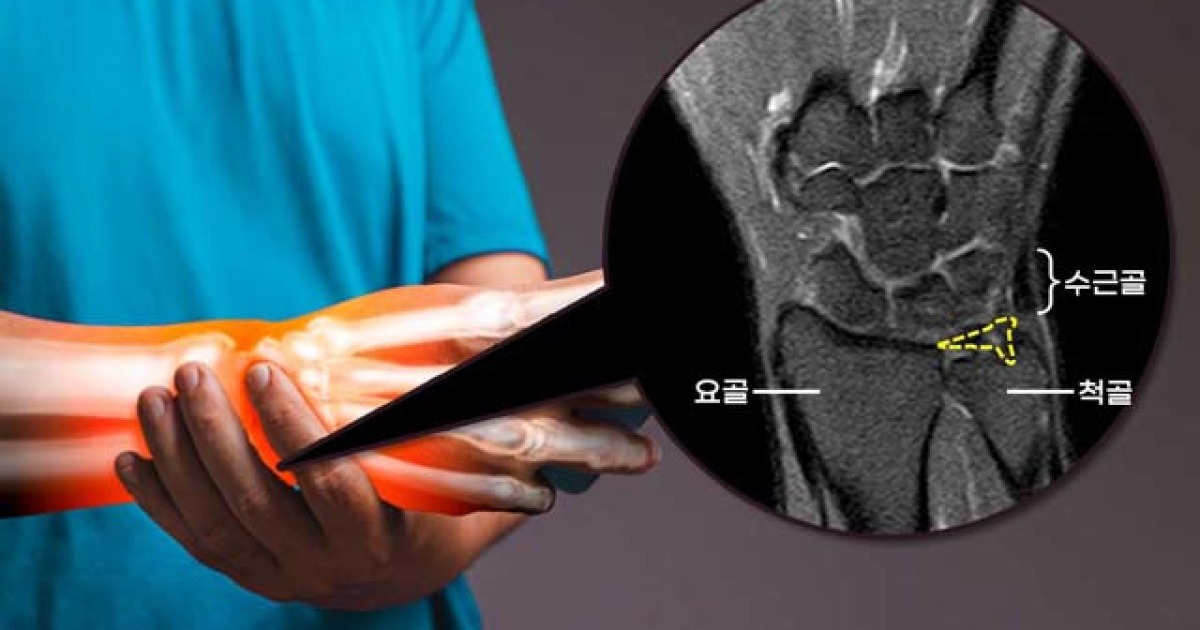 손목 과사용 통증… 삼각섬유연골 복합체(TFCC) 어떻게 치료하나? [곽상호의 손·손목 이야기]