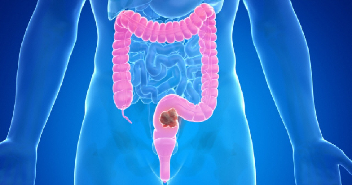 혈변, 변비, 치질이? 대장암 증상 살피는 법 5