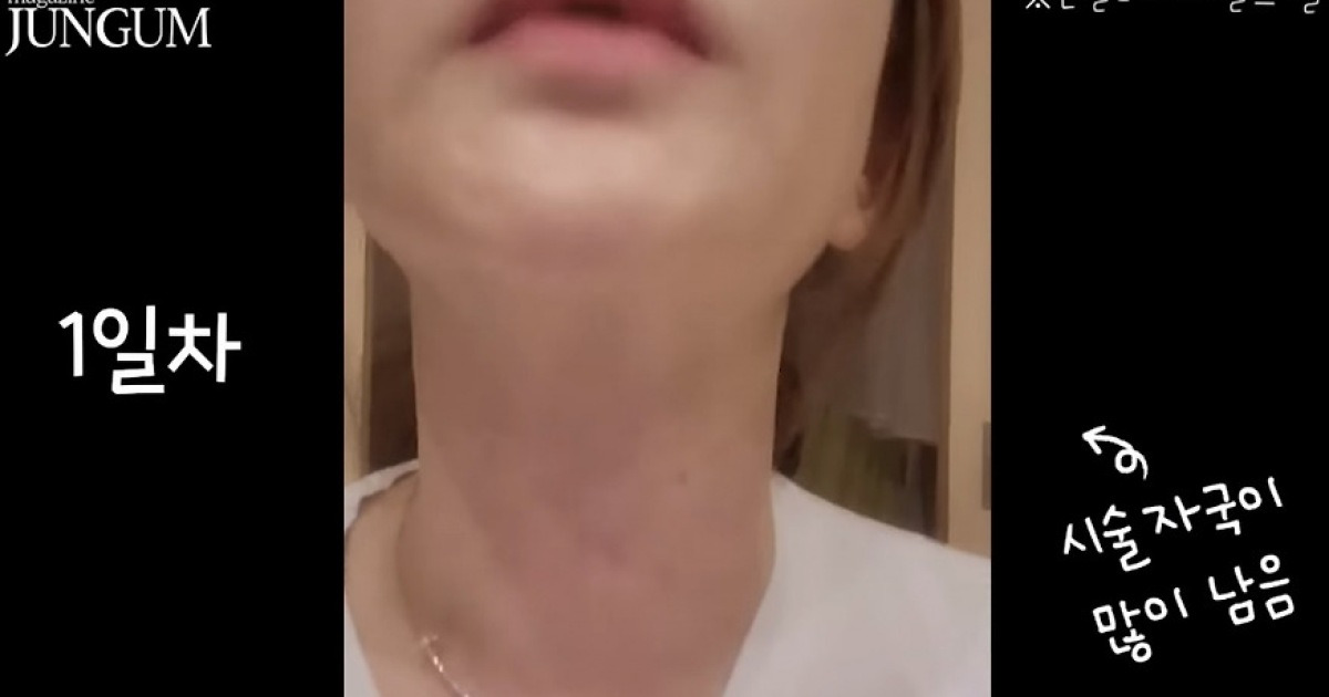 피부병처럼 붉어졌는데… 61세 박준금 목주름 고민