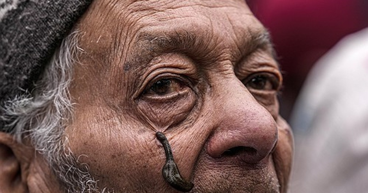 India Kashmir Leech Therapy